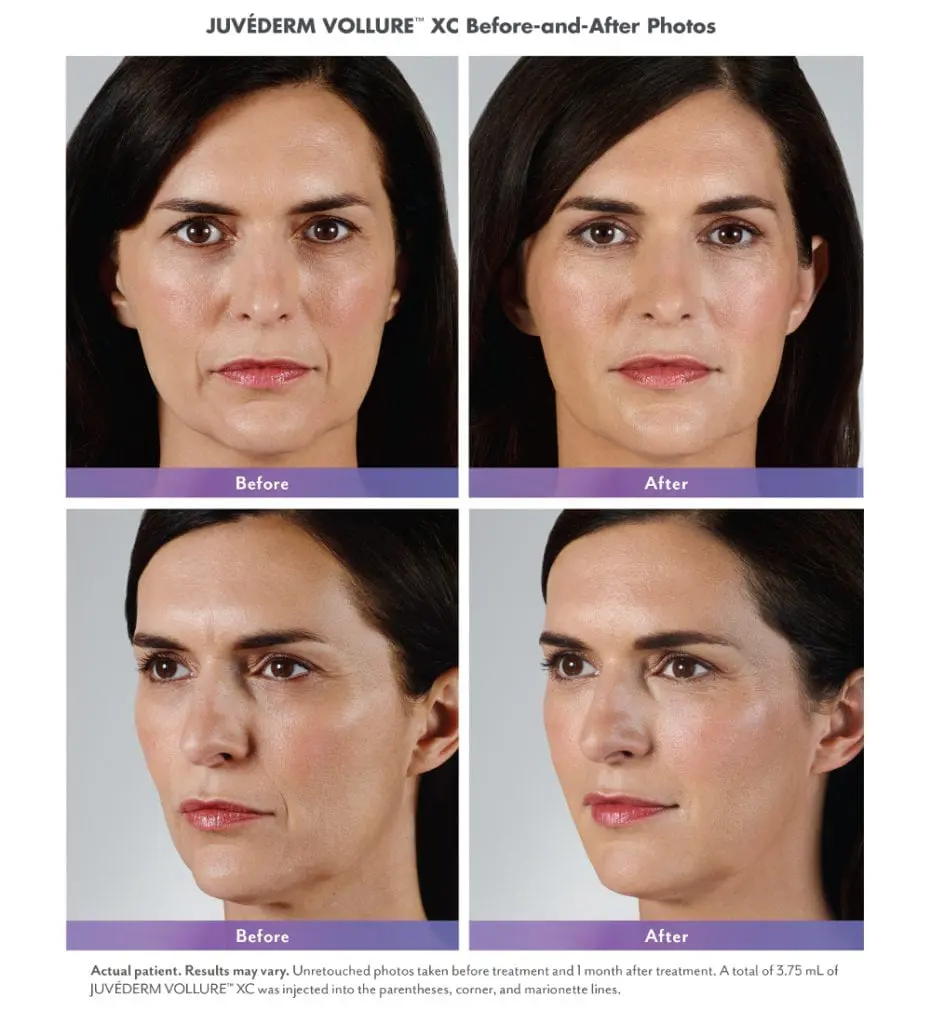 Injectable Dermal Fillers East Bay | MSpa